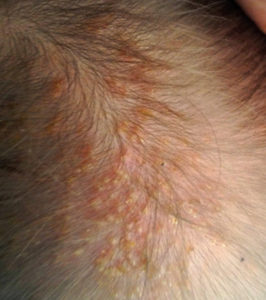 Eosinophilic Pustular Folliculitis in Infancy images | Dermatology Games