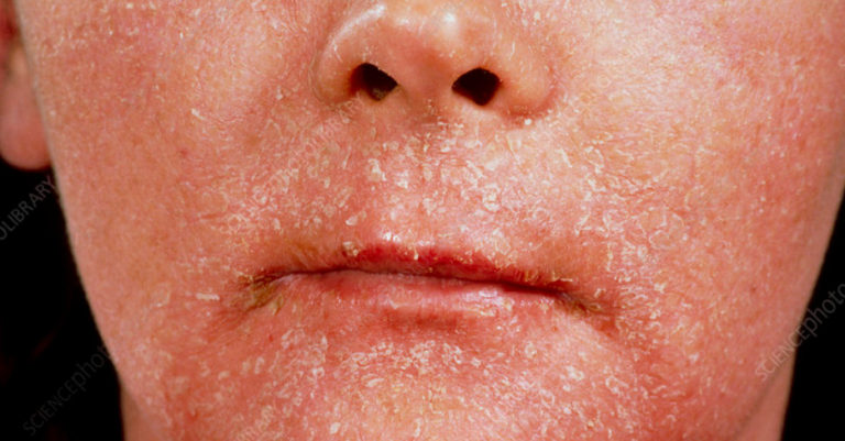 Persistent Facial erythema (Red face) | Dermatology Games