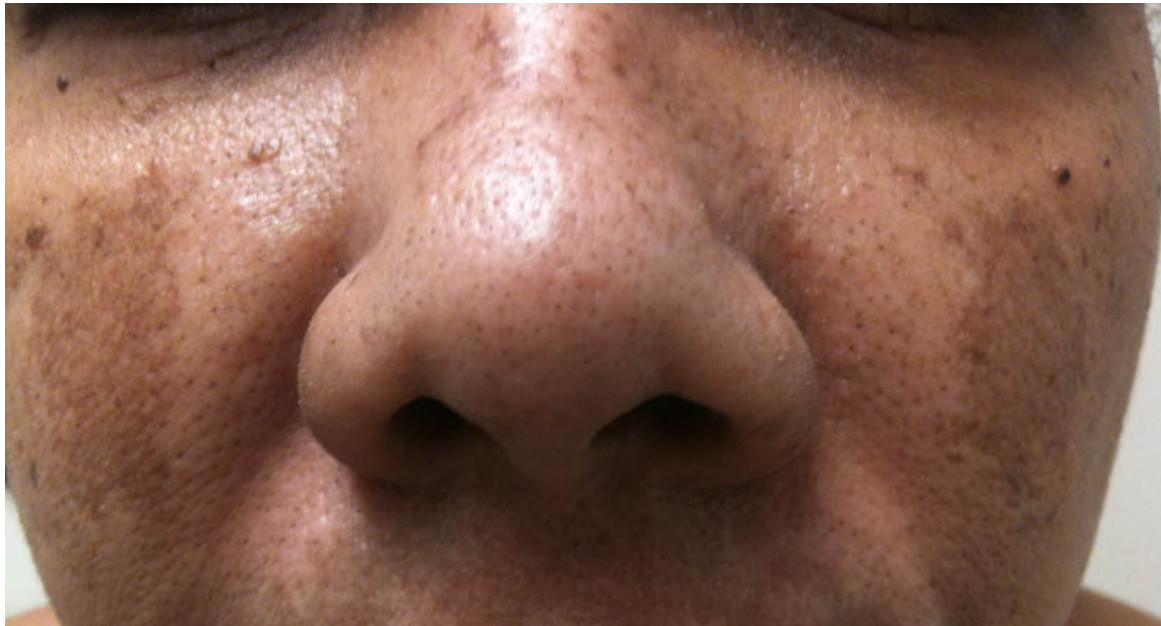 Acquired Facial Hyperpigmentation | Dermatology Games