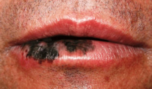 Hyperpigmented lip lesions differntial diagnosis | Dermatology Games