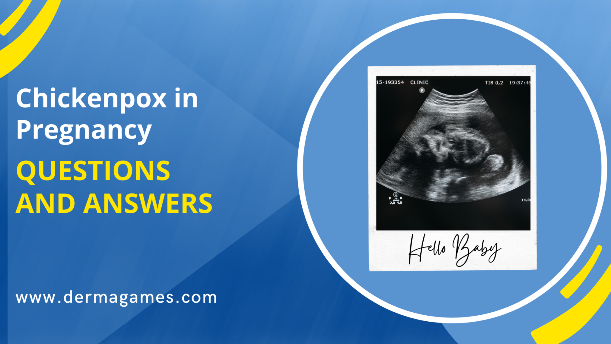 Chickenpox in Pregnancy: Your Comprehensive Q&A Guide | Dermatology Games